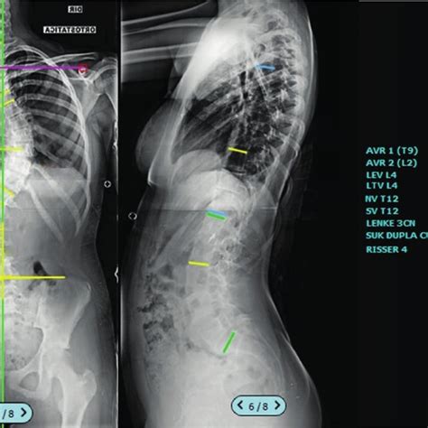 Patients Classified According To Rigo Classification And Their