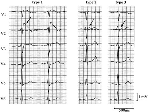 Brugada Syndrome Types Diagnosis Geeky Medics