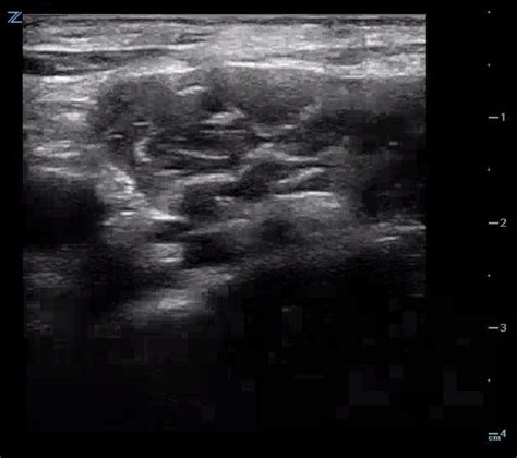 Votw Interscalene Brachial Plexus Block — Maimonides Emergency Medicine Residency