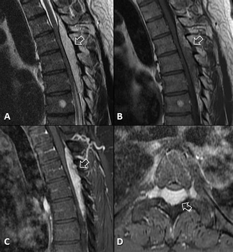 Four Cases Of Spinal Epidural Angiolipoma Journal Of Clinical