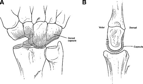Pdf Proximal Row Carpectomy Semantic Scholar