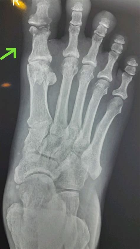 Displaced Intraarticular Fracture Of Head Of Proximal Phalanx Hallux