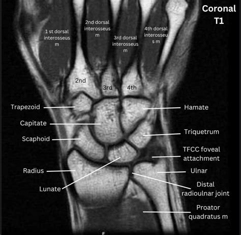 Wrist Anatomy Mri