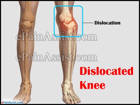 Knee Dislocation Or Dislocated Kneetreatmentdiagnosisrisk Factorscomplications