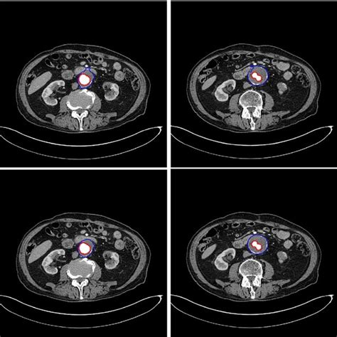An Example Of Segmentation By The Two Pipelines With Axial