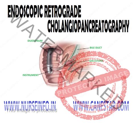 Endoscopic Retrograde Cholangiopancreatography Nurse Info