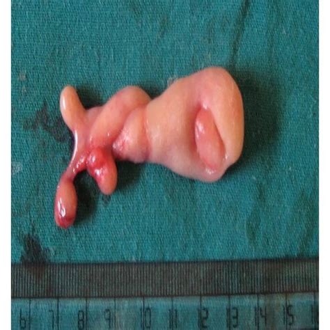 A T2 Weighted Mri Sagittal Image Showing The Tonsillar Polyp With The Download Scientific