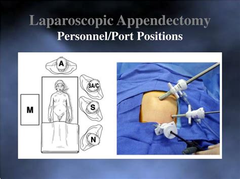 Ppt Appendicitis Current Management Powerpoint Presentation Id 1181625