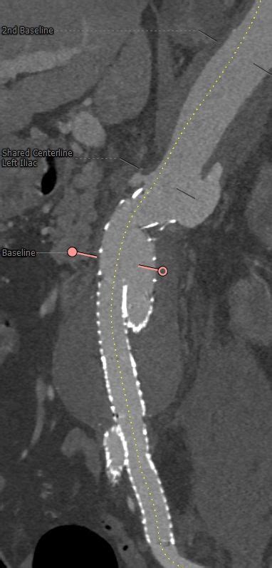 Pmeg Fevar Hungaroring4pmeg Conformable Excluder Valiant