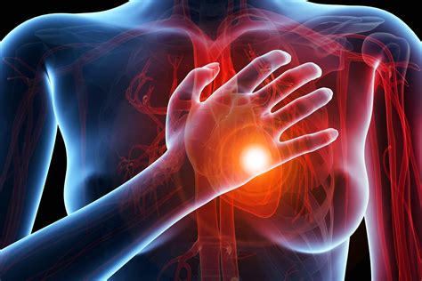 Aprendiendo Con Enfermeros Infarto