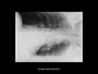 Chest X Ray How To Read A Cxr Ppsx