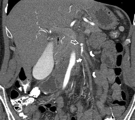 Coronal Arterial Phase Ct Image Of The Abdomen In An Individual With