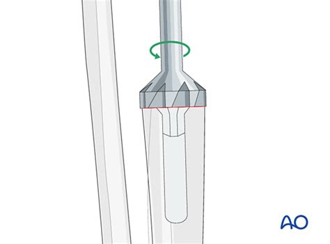 Proximal Tibia Replacement For Fracture Around A Loose Tibial Component With Poor Bone Stock