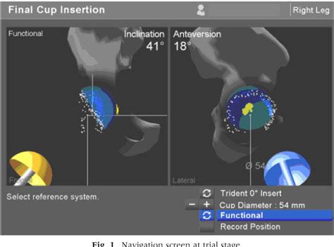 Figure 1 From Comparison Of Cemented Vs Uncemented Acetabular Component
