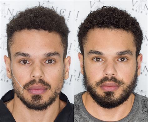 Tired Of Patchy Beard Growth Heres How A Beard Transplant At Vinci
