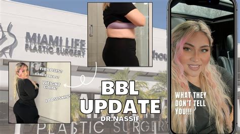 Bbl Update 10 Months Po Miami Life Dr Nassif Before And After