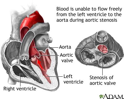 Aortic Stenosis Medlineplus Medical Encyclopedia