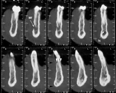 Ct Dentascan Scan Of Mandible A Axial Image With Superimposed