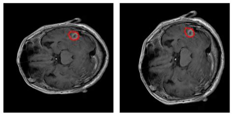 A Deep Learning Approach For Brain Tumor Classification And Segmentation Using A Multiscale