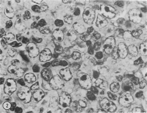 Nodular Histiocytic Lymphoma Predominant Cells Have Large Vesicular Download Scientific