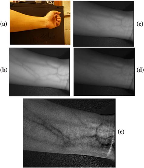 High Contrast Subcutaneous Vein Detection And Localization Using Multispectral Imaging