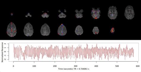 MultiBand SENSE Widens Possibilities FMRI DMRI Brain FieldStrength Philips