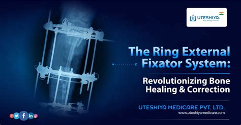 The Ring External Fixator System Transforming Bone Reconstruction And Healing Orthopedic