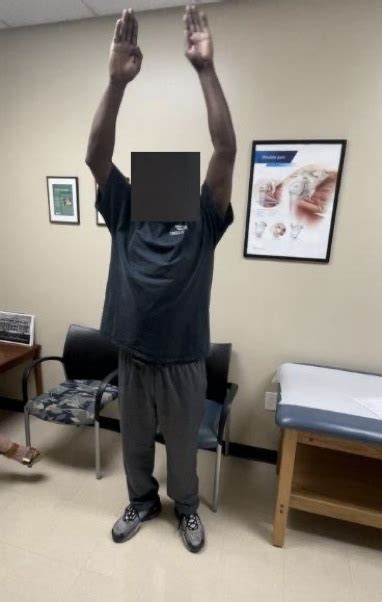 Reconstruction Of Chronic Acromioclavicular Dislocation With