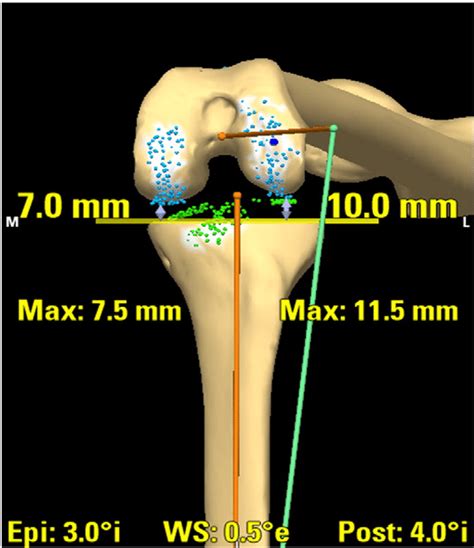 Tibia Rotation Is Set By Aligning The Mechanical Axis Green Line With Download Scientific