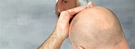 Scalp Micropigmentation Chicago Hair Tattoo Chicago And Beard Scalp Micropigmentation Chicago Hair Tattoo Chicago And Beard