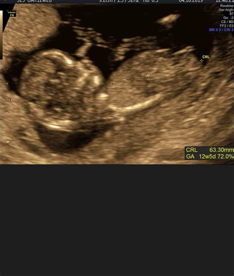 Babe Or Girl Ultrasound Wrong Gender Scan Accuracy