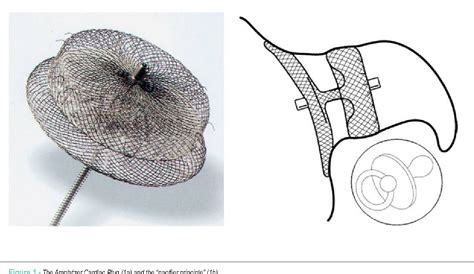Figure 1 From Left Atrial Appendage Closure With The Amplatzer Cardiac