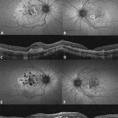 Multimodal Imaging Of A 29 Year Old Woman With Multifocal Choroiditis