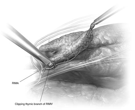 Thoracoscopic Thymectomy Operative Techniques In Thoracic And