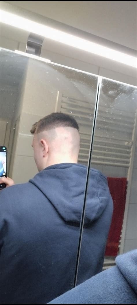 Is This Alopecia Ophiasis R Alopecia Areata