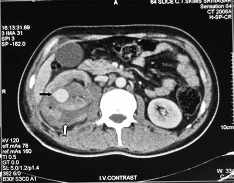 E Cect Abdomen Showing Pseudoaneurysm Black Arrow And Perinephric Download Scientific Diagram