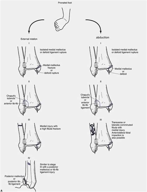 The Lauge Hansen Orthopaedic Cases Discussion Facebook
