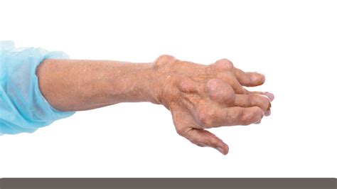 What Is Polyarthritis Klarity Health Library