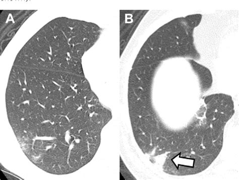 Figure 1 From Multimodal Indirect Imaging Signs Of Pulmonary Embolism