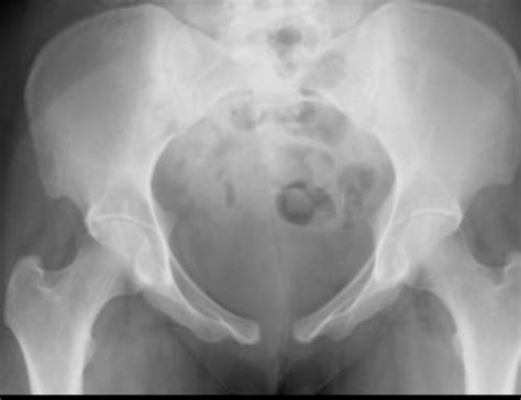 Lower Extremity Radiographs Flashcards Quizlet