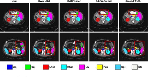 [pdf] Beyond Self Attention Deformable Large Kernel Attention For Medical Image Segmentation