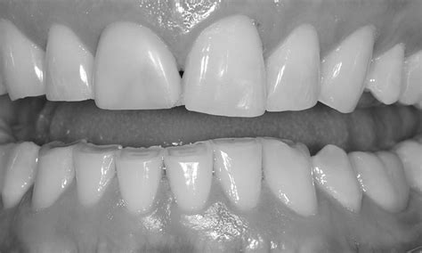 Bruxismo Severo O Que é E Como Recuperar Os Desgastes Nos Dentes