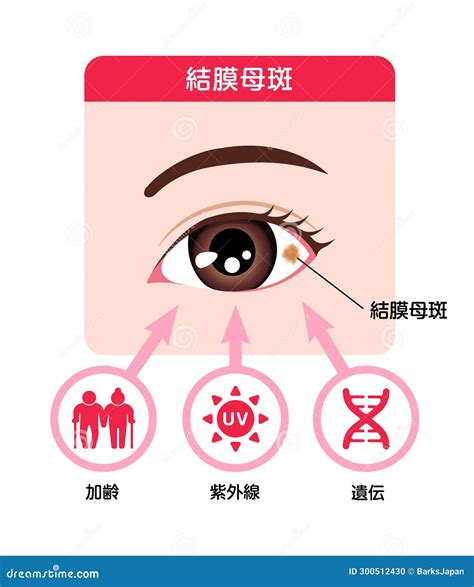 Causes Of Conjunctival Nevus Vector Illustration 300512434