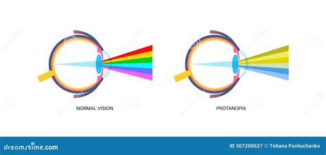 Protanomaly And Protanopia Stock Vector Illustration Of Spectrum