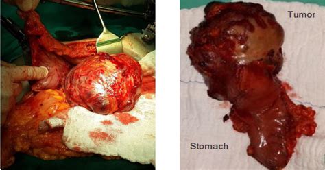 Intraoperative And Back Table Specimen Appearances Of Gist Arising From