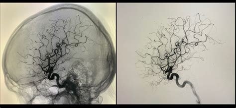 Cerebral Dsa Stroke ID