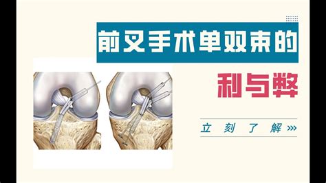 膝关节前叉手术单束与双束的利与弊 Youtube