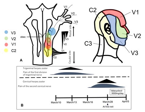 Trigeminal Ganglion Herpes