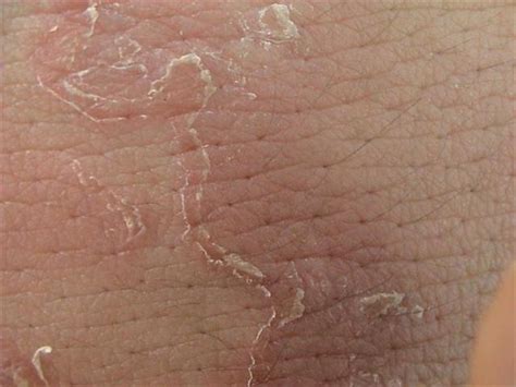 Ichthyosis Linearis Circumflexa