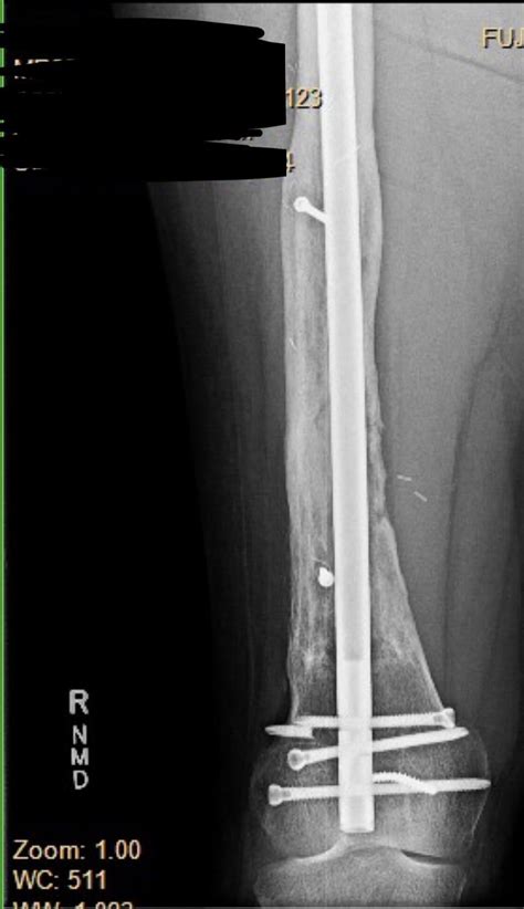My Femur Resection 12 Years Later Rradiology